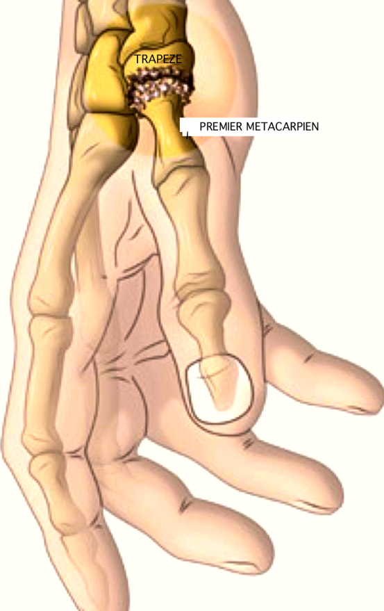 rhizarthrose (arthrose de la racine du pouce), chirurgien specialiste main