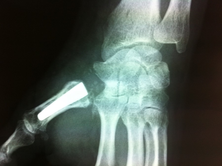 rhizarthrose (arthrose de la racine du pouce), chirurgien specialiste main